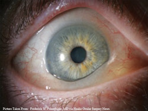 Conjunctivochalasis-Related Dry Eye