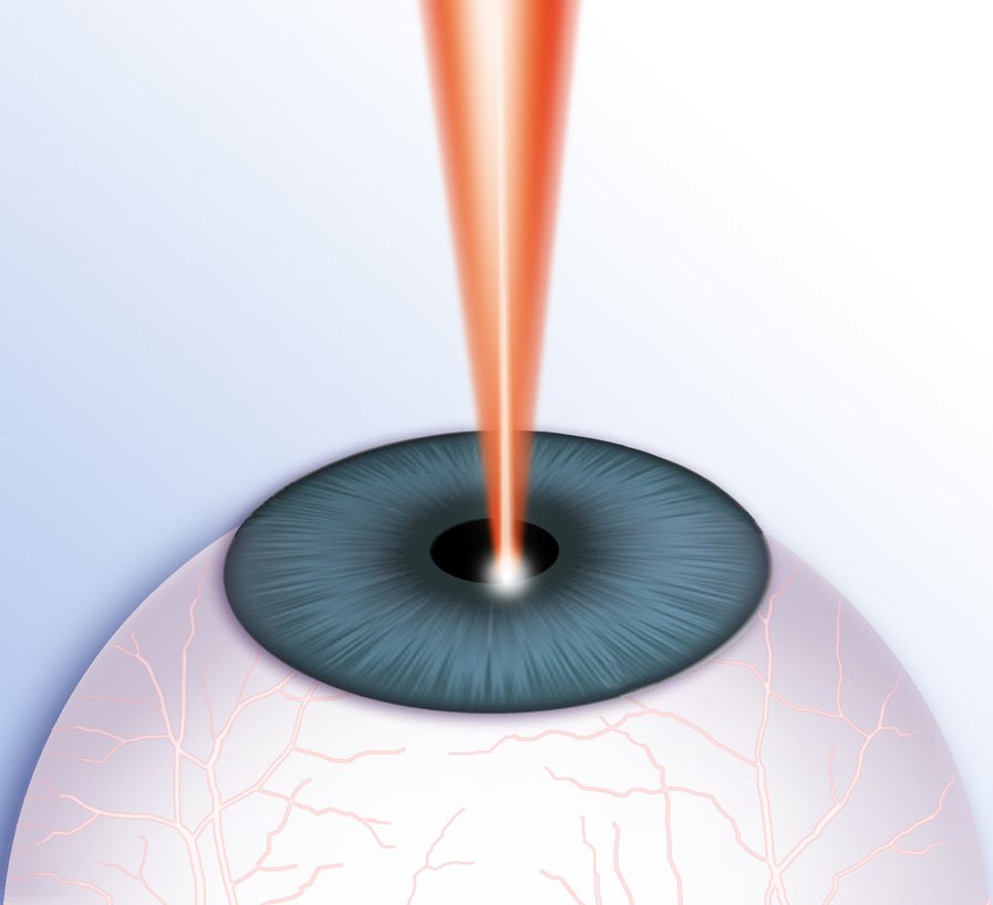 Top 5 Reasons Why You Should Have LASIK Eye Surgery